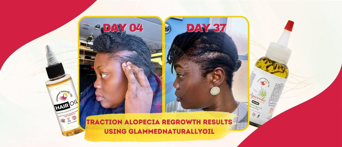 Traction alopecia before and after results